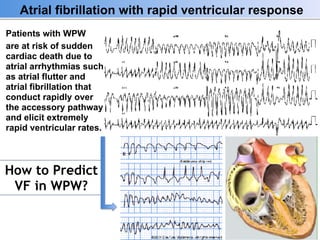 Síndrome de Wolff Parkinson-White | PDF
