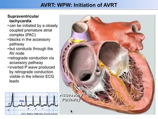 Síndrome de Wolff Parkinson-White | PDF