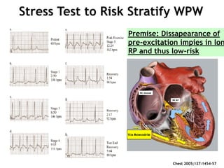 Síndrome de Wolff Parkinson-White | PPT