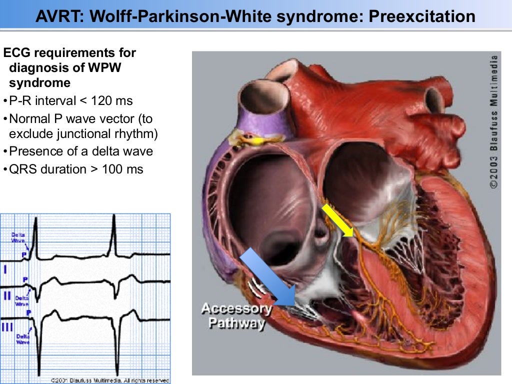 Síndrome de Wolff Parkinson-White