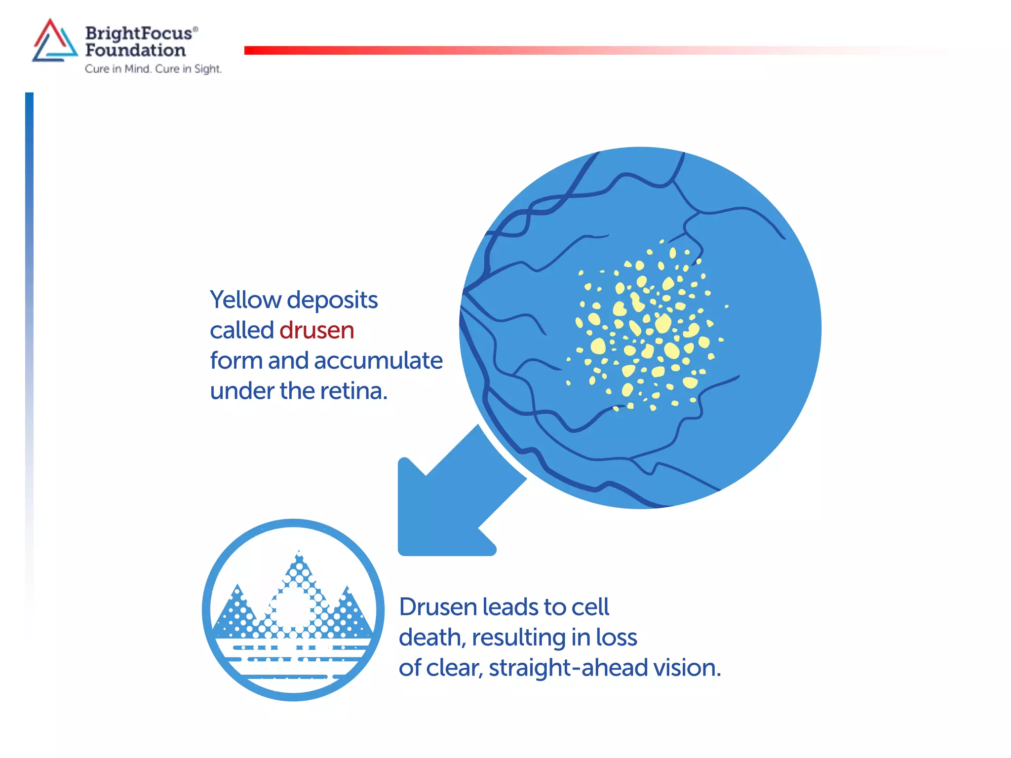 A Look at Macular Degeneration: A Leading Cause of Vision Loss | PPTX ...