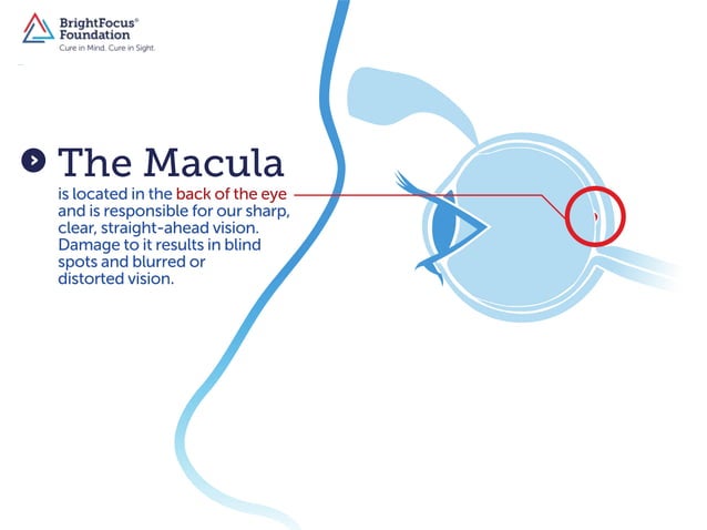 A Look at Macular Degeneration: A Leading Cause of Vision Loss | PPTX ...