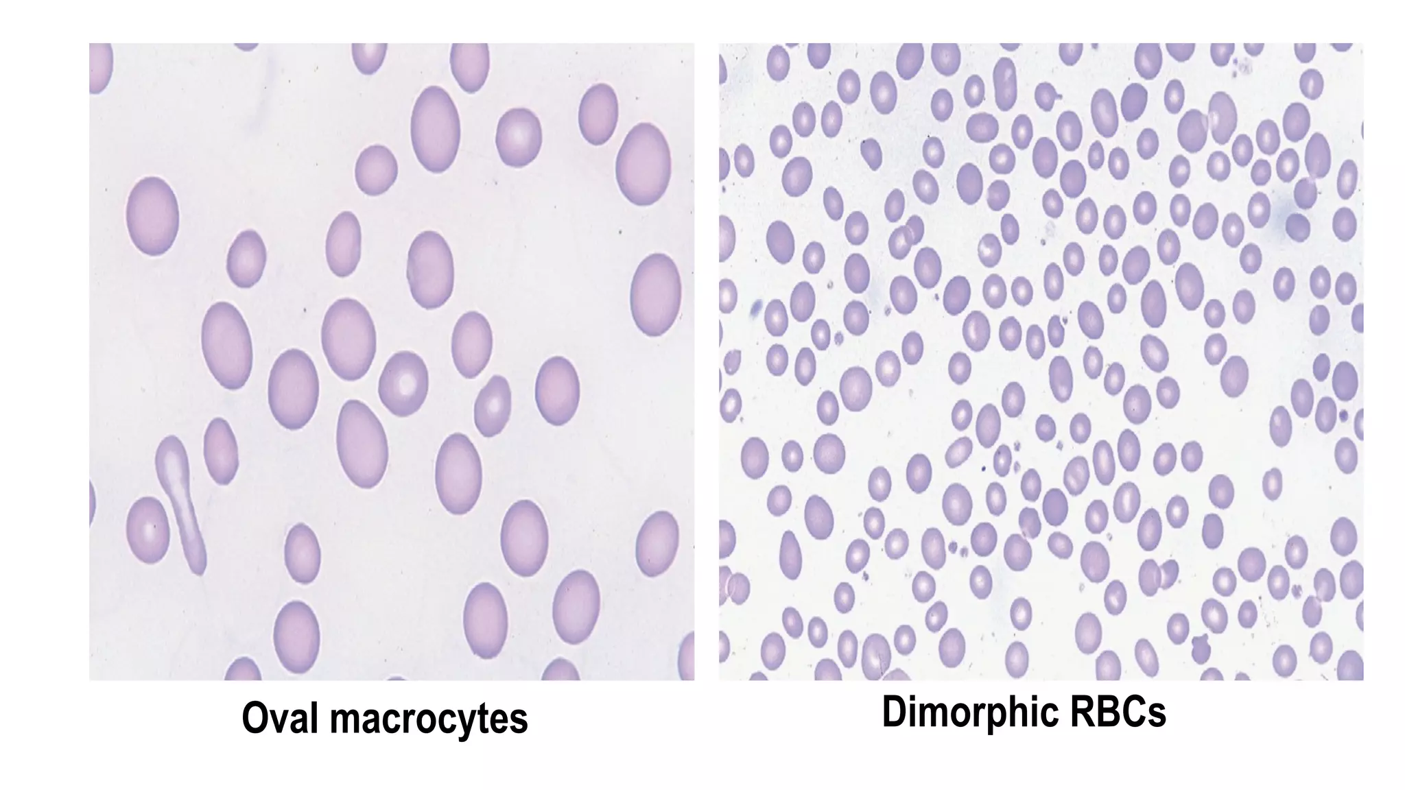 Myelodysplastic Syndromes (MDS) | PDF
