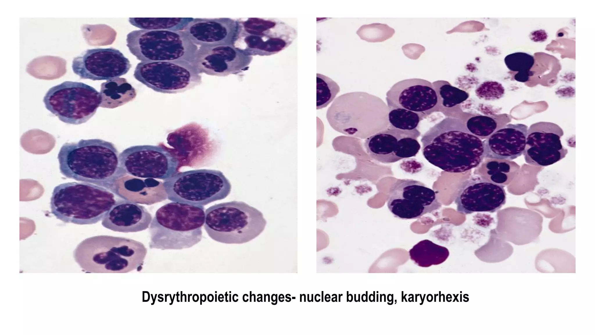 Myelodysplastic Syndromes (MDS) | PDF