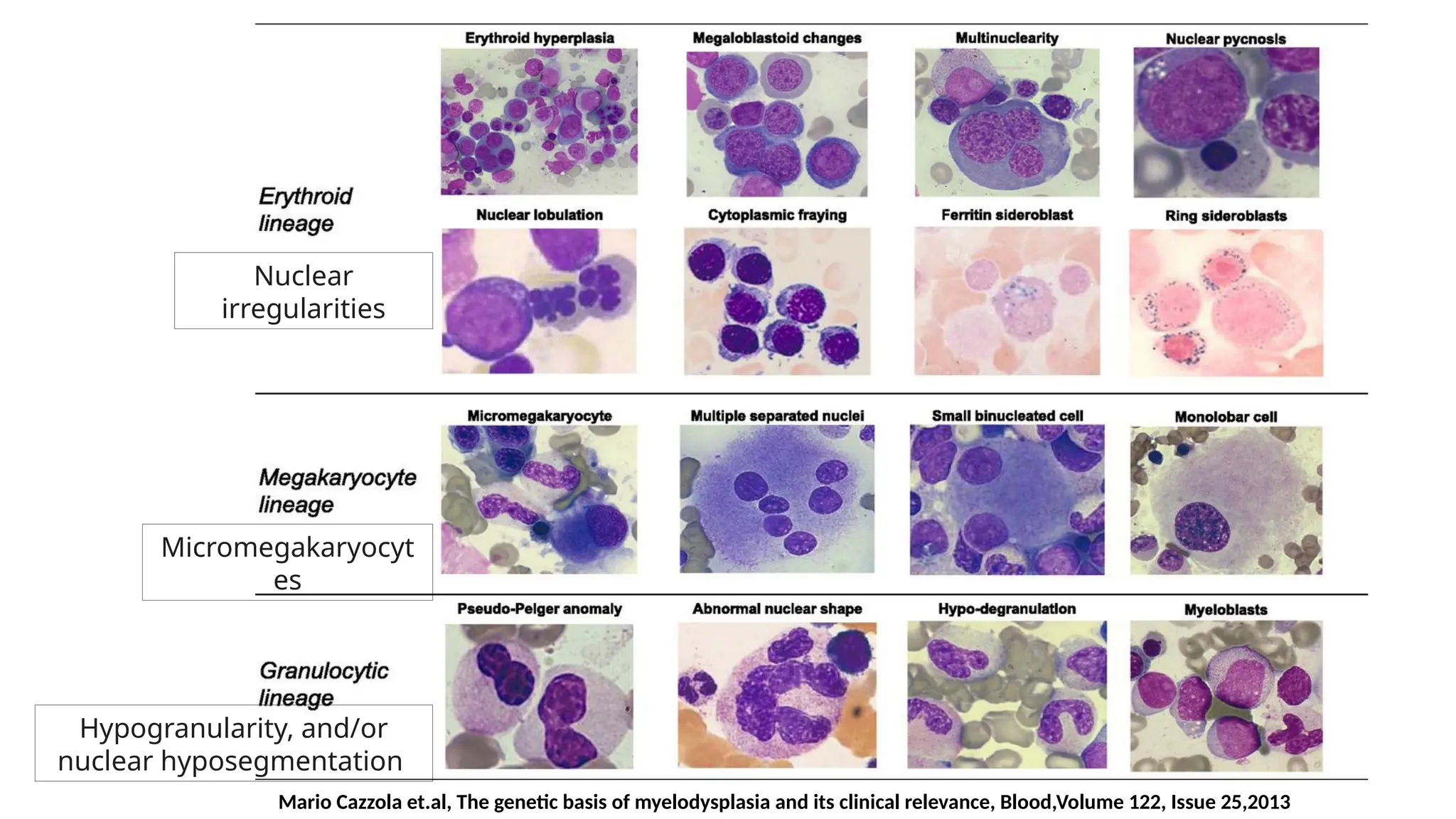 DIAGNOSIS OF MYELODYSPLASTIC SYNDROMES/NEOPLASMS | PPTX