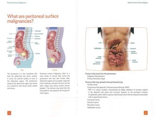 Multidisciplinary Approach in a Peritoneal Surface Malignancy Program | PPTX