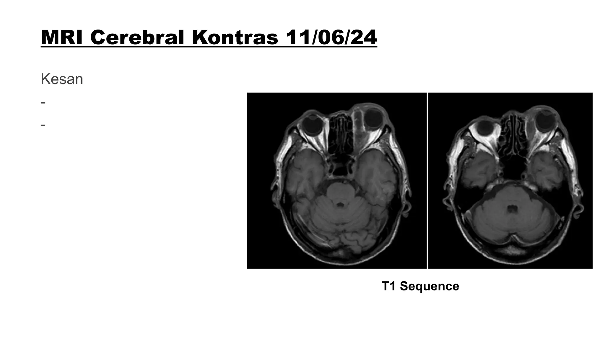 Kasus laki-laki dengan abses periosteal orbita.pptx