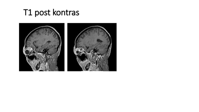 Kasus laki-laki dengan abses periosteal orbita.pptx
