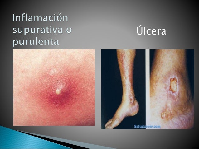 Módulo 3 inflamación