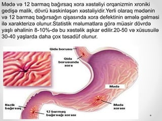 Mədə və onikibarmaq bağırsaq xoraları | PPTX