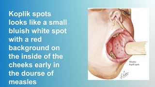 MEALES (a childhood infectious disease) | PPT