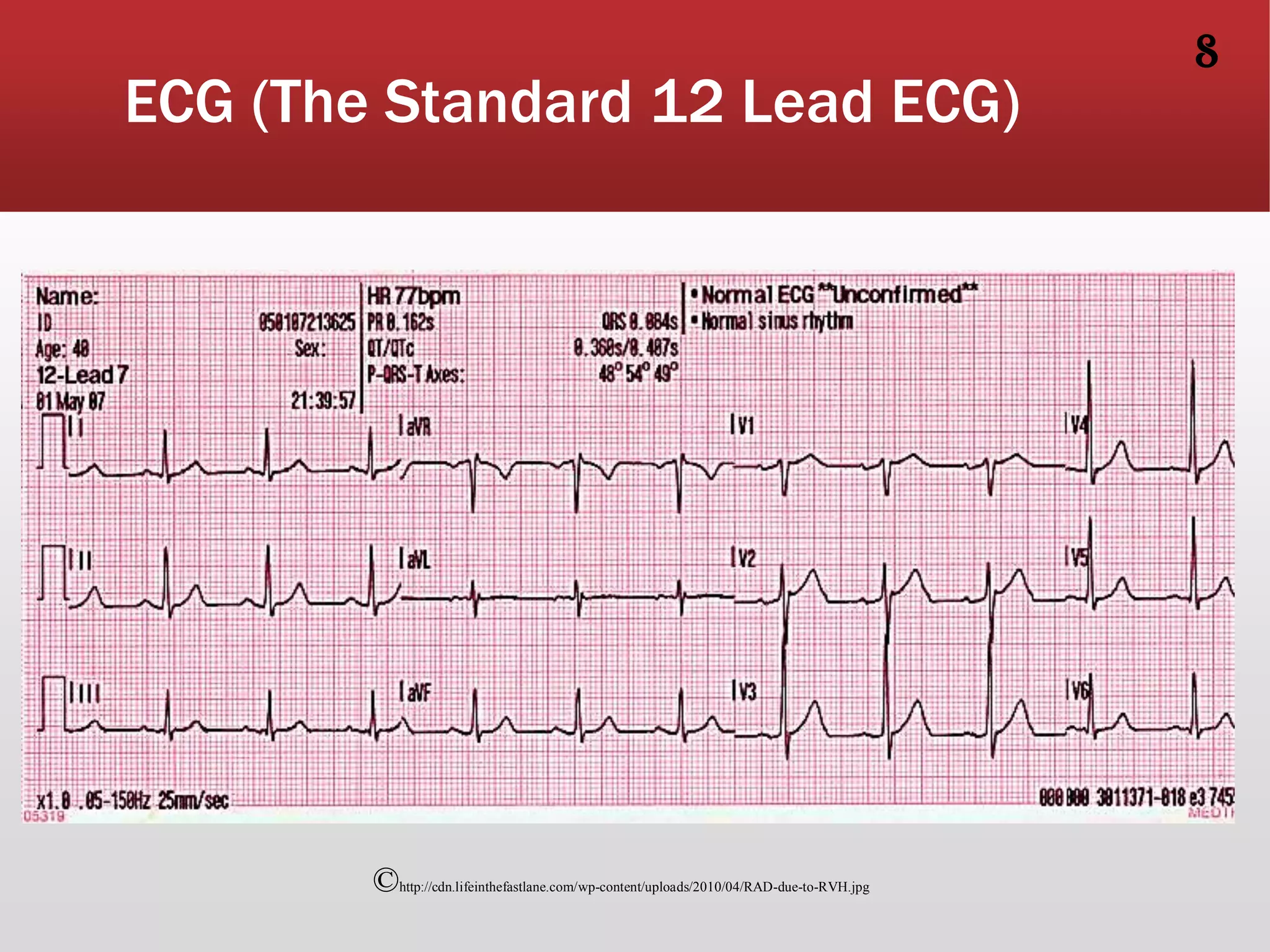 Mean cardiac axis (cardiac vector) | PPT