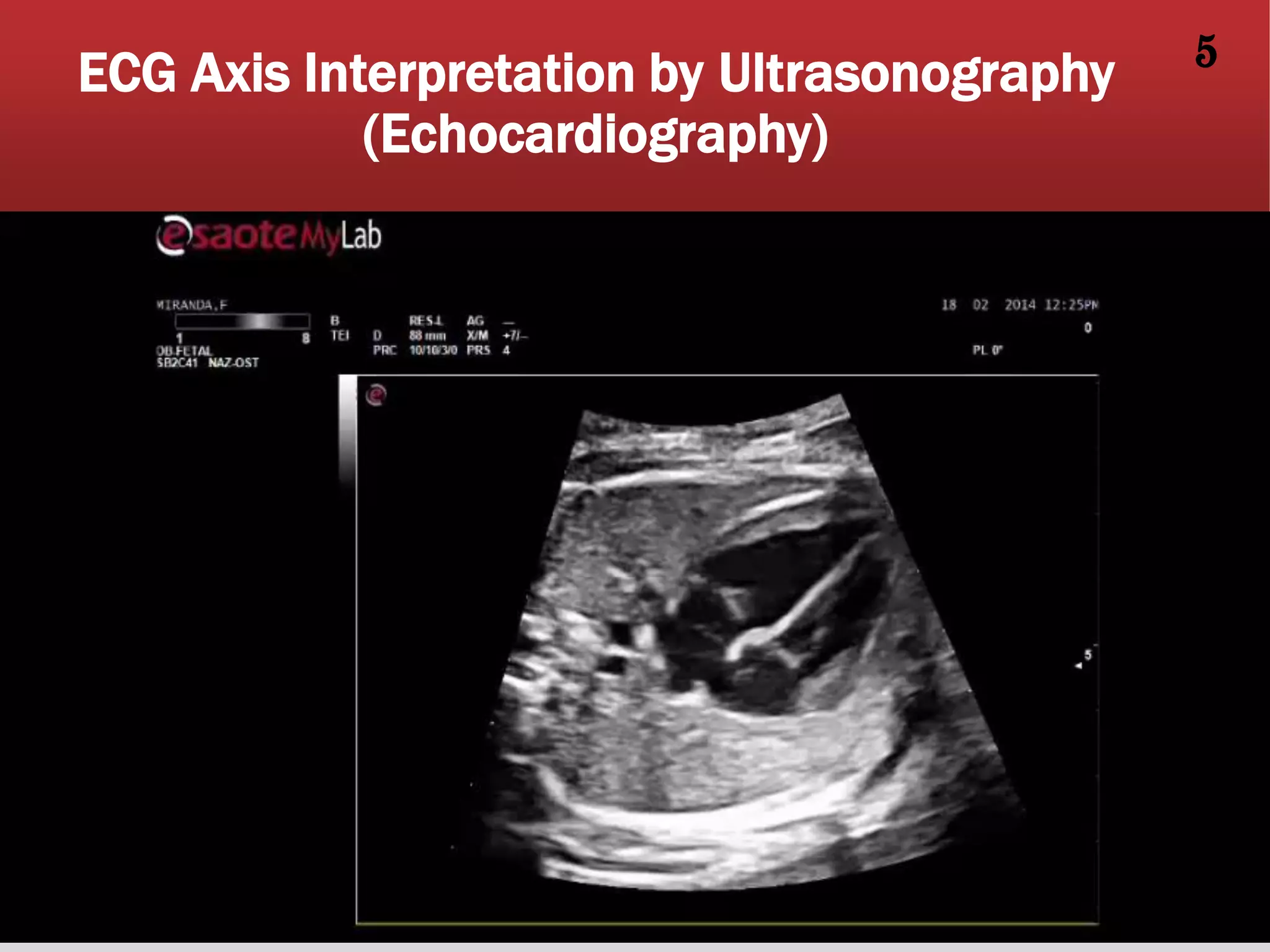Mean cardiac axis (cardiac vector) | PPT
