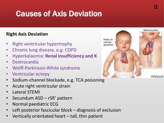 Mean cardiac axis (cardiac vector) | PPT