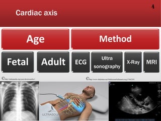Mean cardiac axis (cardiac vector) | PDF