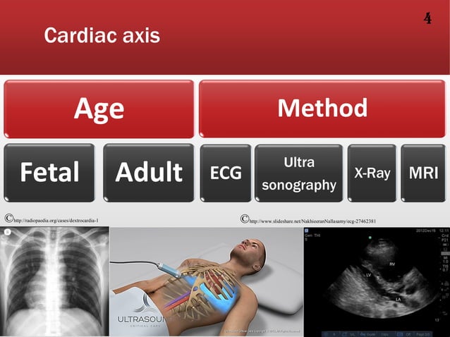 Mean cardiac axis (cardiac vector) | PPT