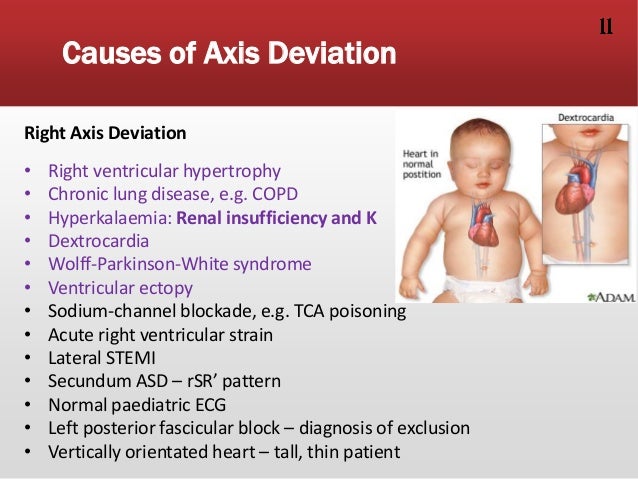Mean cardiac axis (cardiac vector)