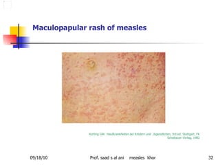 Measles | PPT