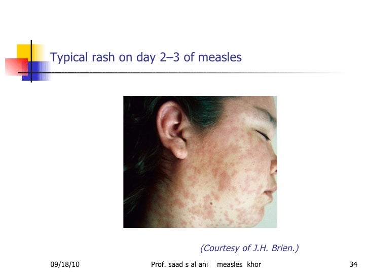 Measles