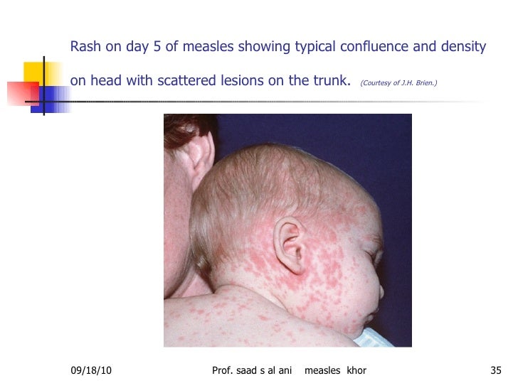 Measles Rash Early Stages Measles Symptoms NHS
