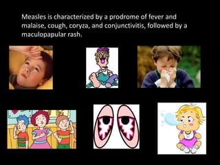 Measles | PPTX