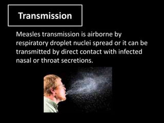 Measles | PPTX
