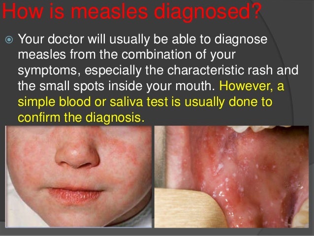 Measles