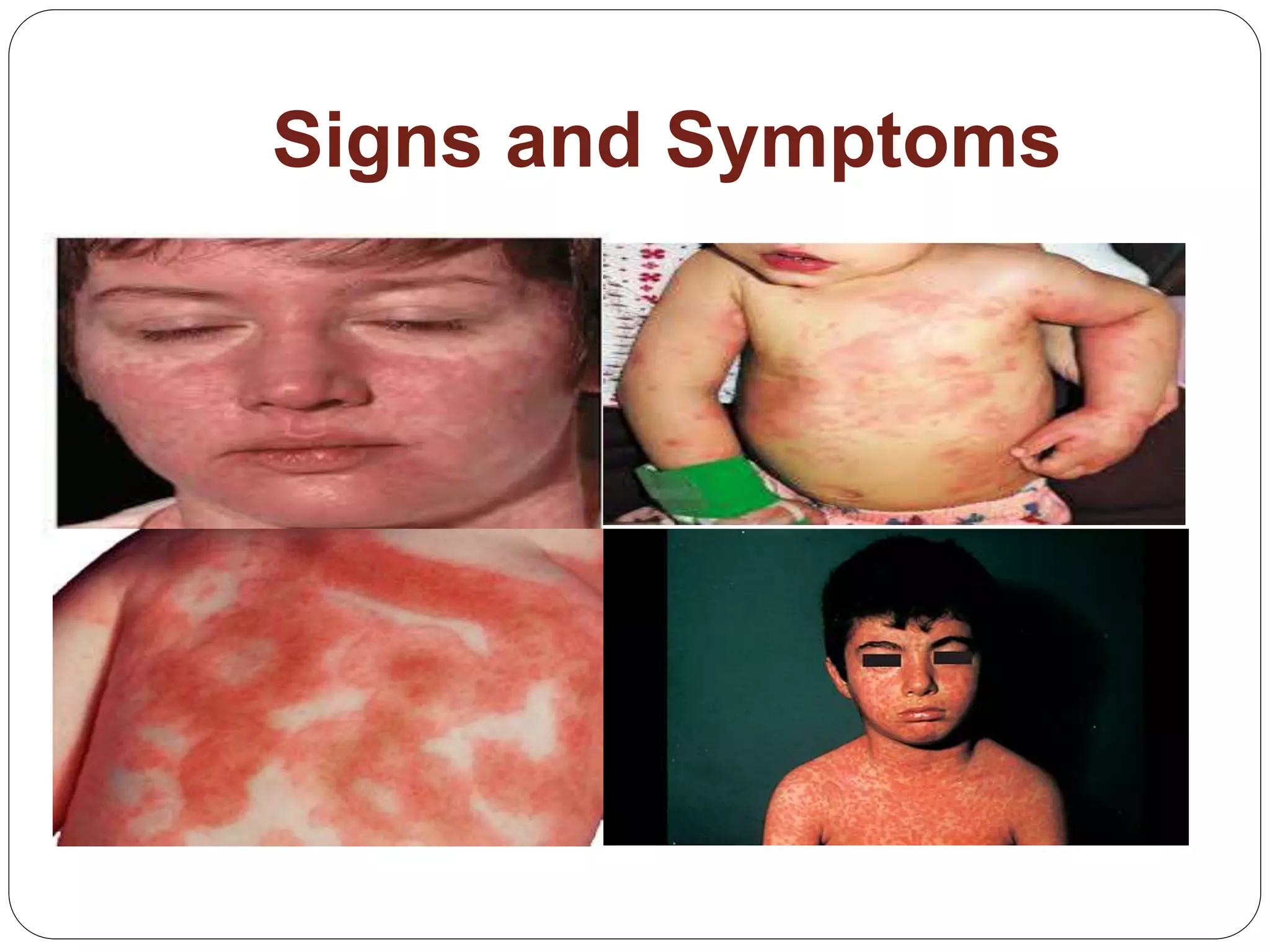 Measles Signs and Symptons | PPT