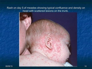 Measles | PPT