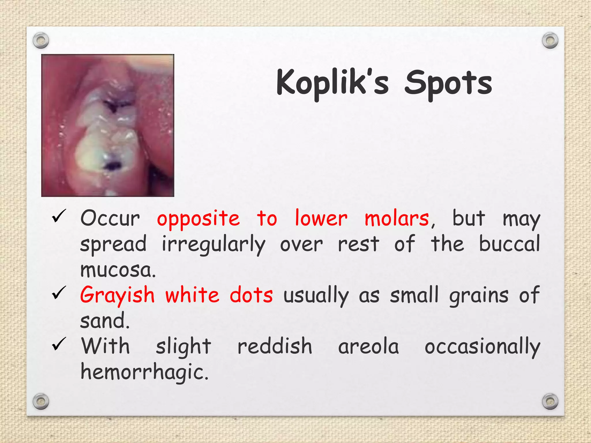 Measles | PPTX