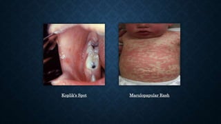 Measles | PPT