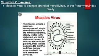 Measles made Ridiculously Easy!!!!!!!!!! | PPT