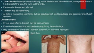 Measles made Ridiculously Easy!!!!!!!!!! | PPTX