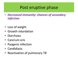 Measles | PPTX