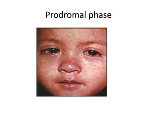 Measles | PPTX | Infectious Diseases | Diseases and Conditions