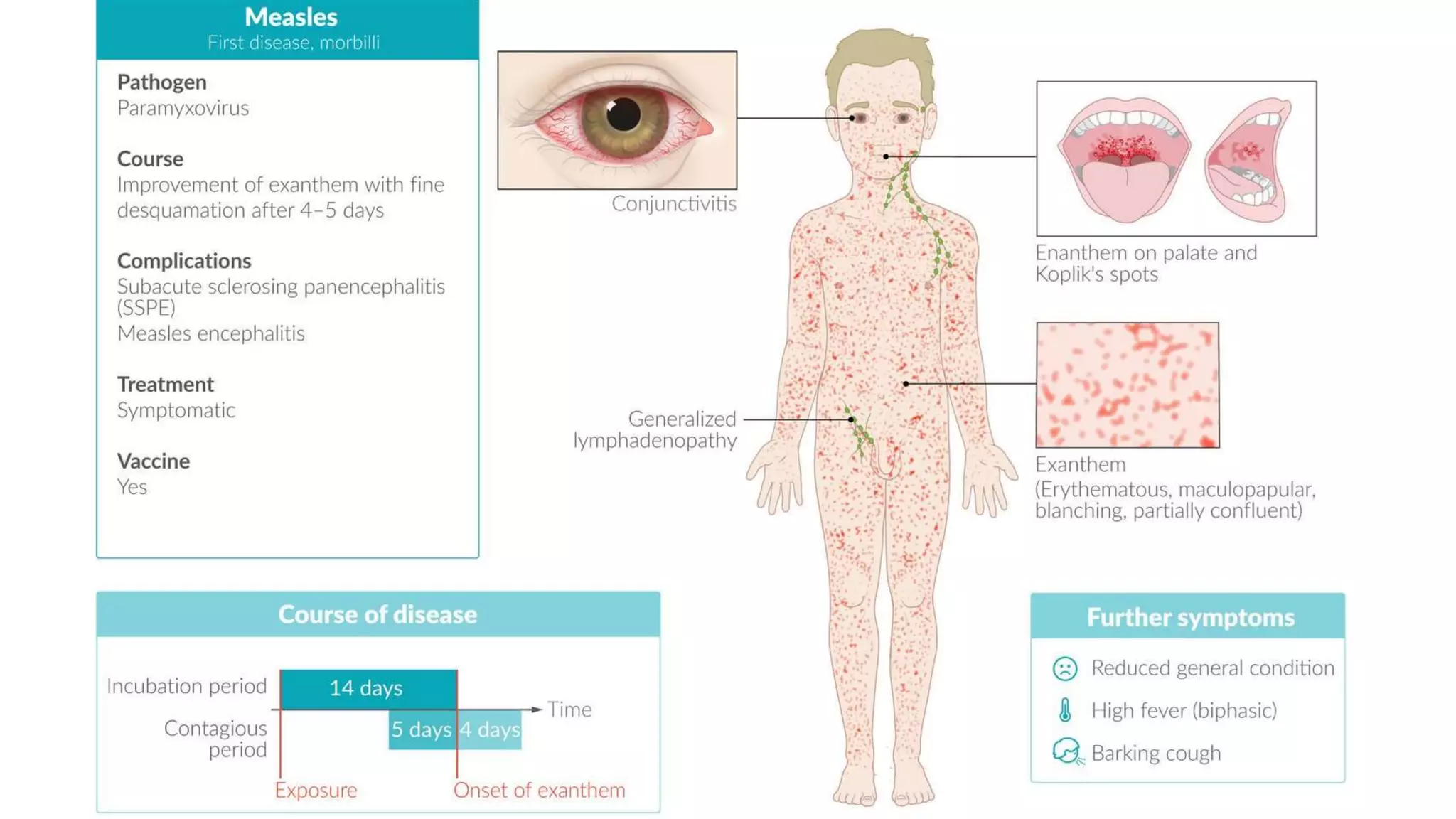 Measles | PPT