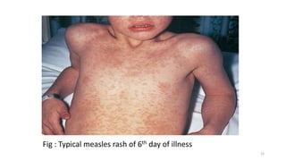 common exanthematous illness: measles | PPTX