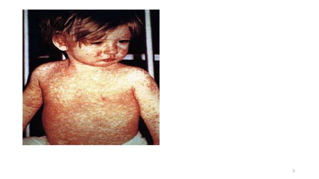 common exanthematous illness: measles | PPTX
