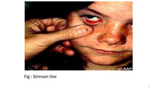 common exanthematous illness: measles | PPTX