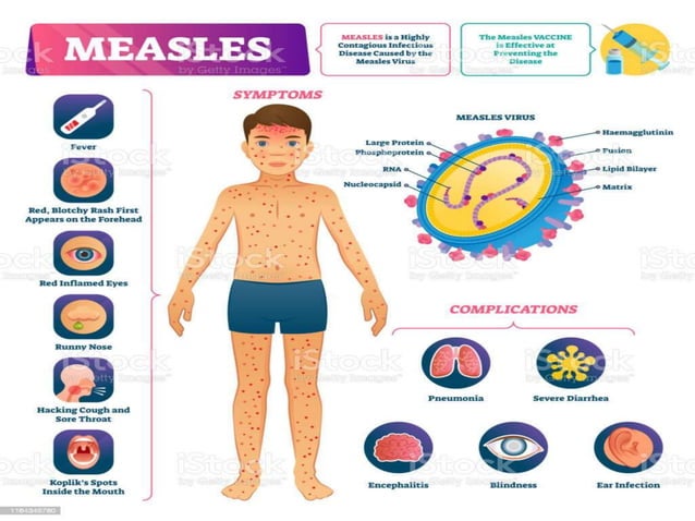Measles.pptx