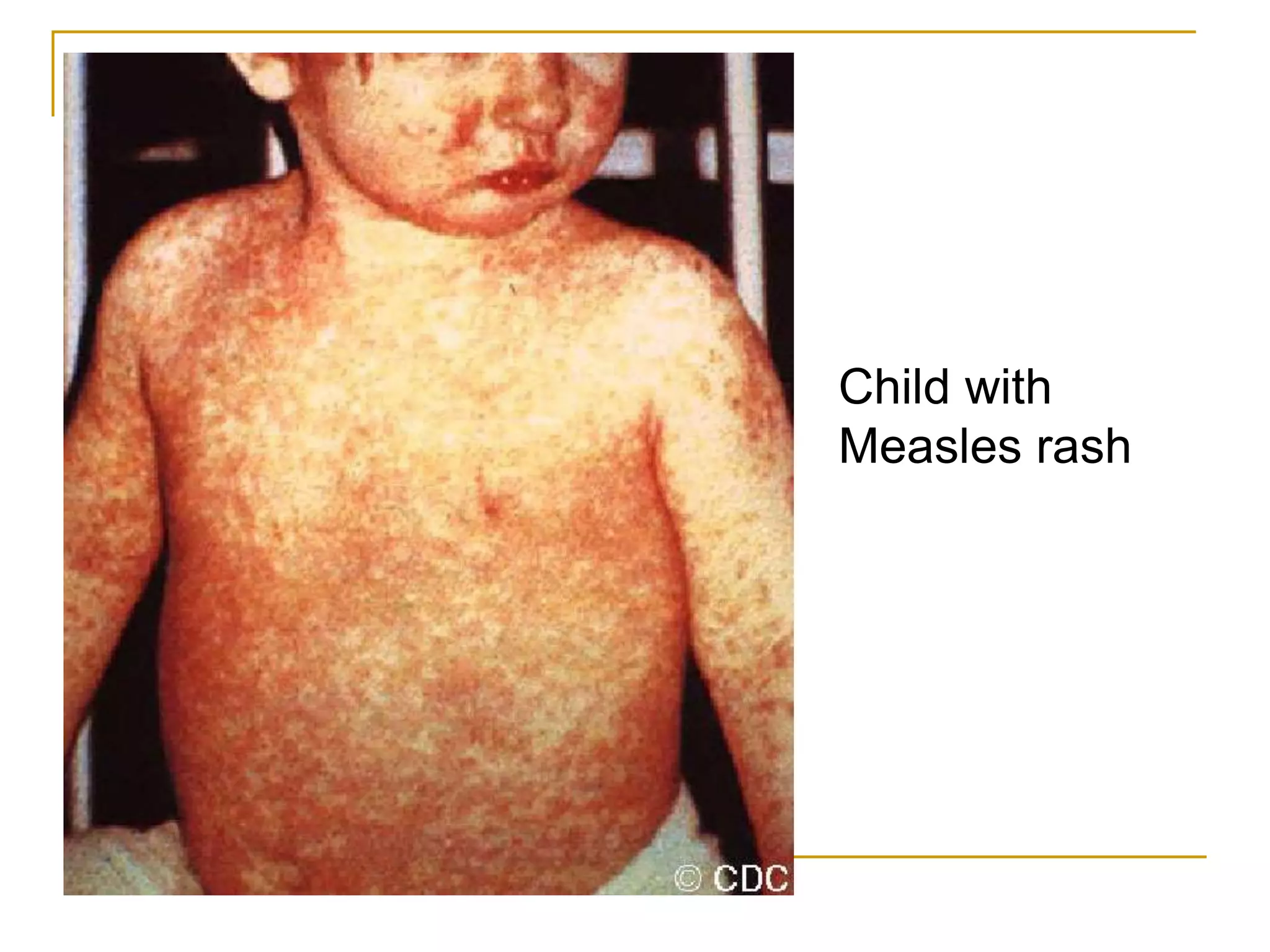 Measles.ppt