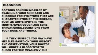 MEASLES | PPT