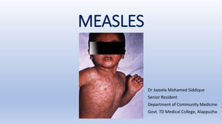 MEASLES.pptx