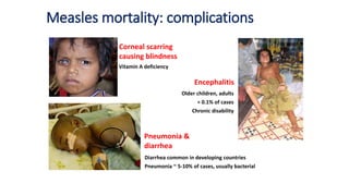 MEASLES.pptx
