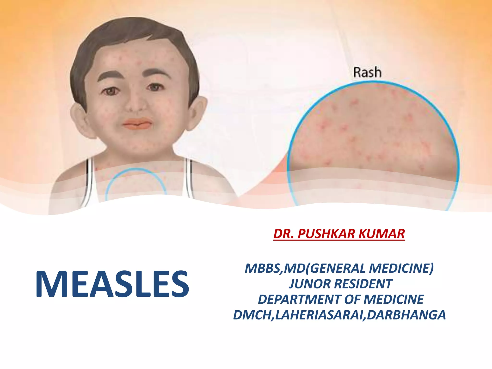 Measles.pptx
