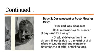 measles.pdf