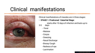 measles.pdf | Infectious Diseases | Diseases and Conditions