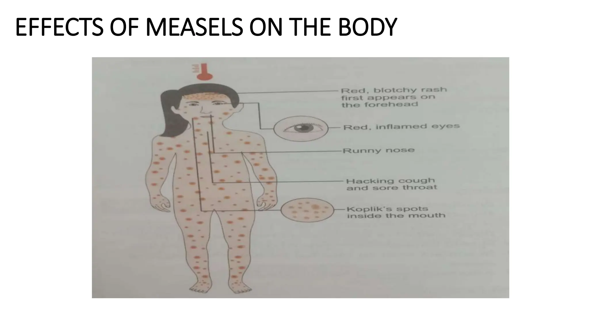 ADULT HEALTH NURAING COMMUNICABLE DISEASE MEASLES.pptx