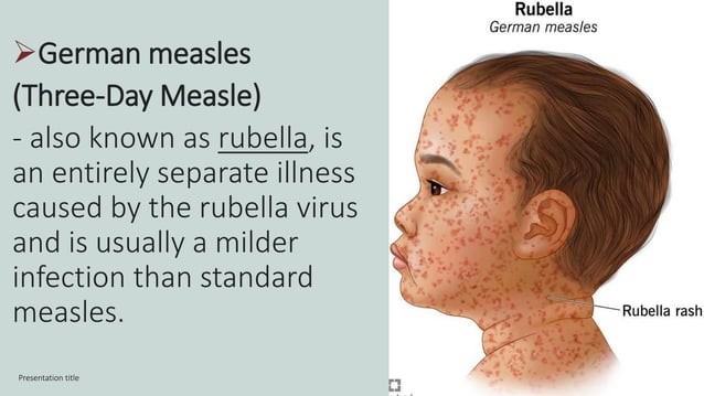MEASLES-CHN-REP..pptx | Infectious Diseases | Diseases and Conditions