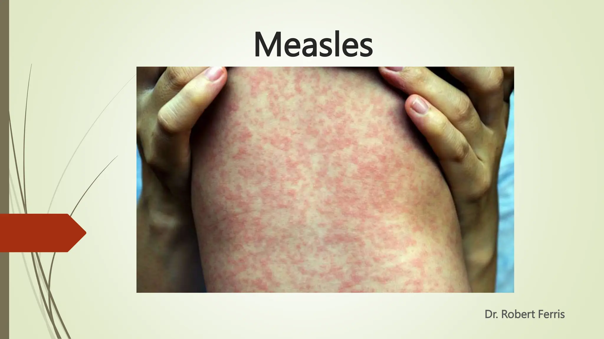 Measles - Clinical Refresher, February 2024 | PPTX